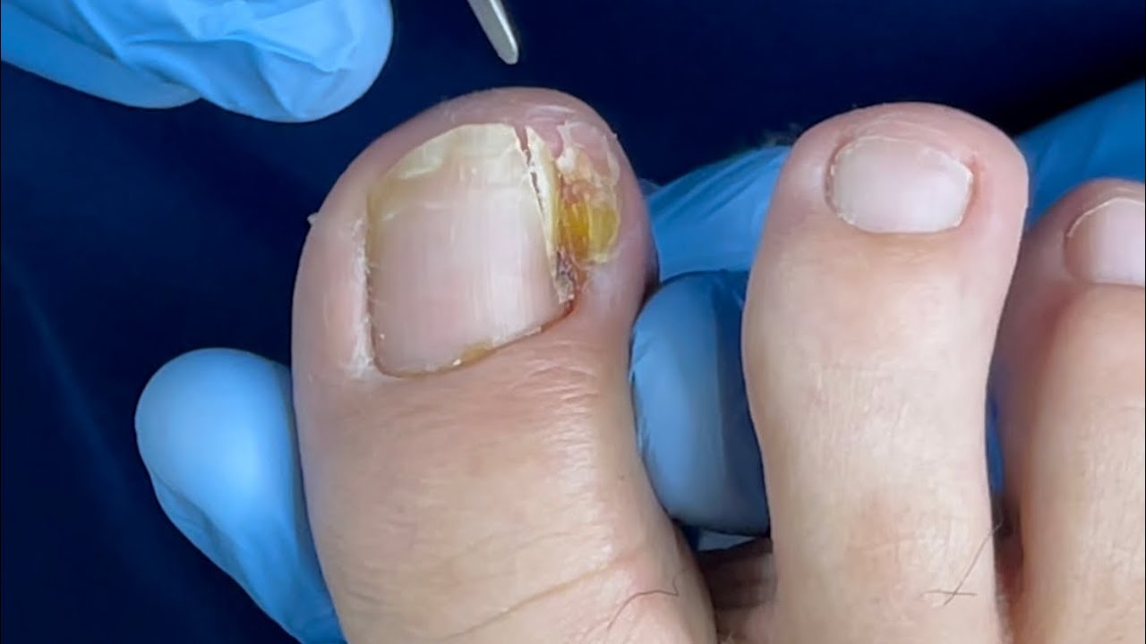 RETIRO DE UÑA ENTERRADA CON GRANULOMA! - YouTube