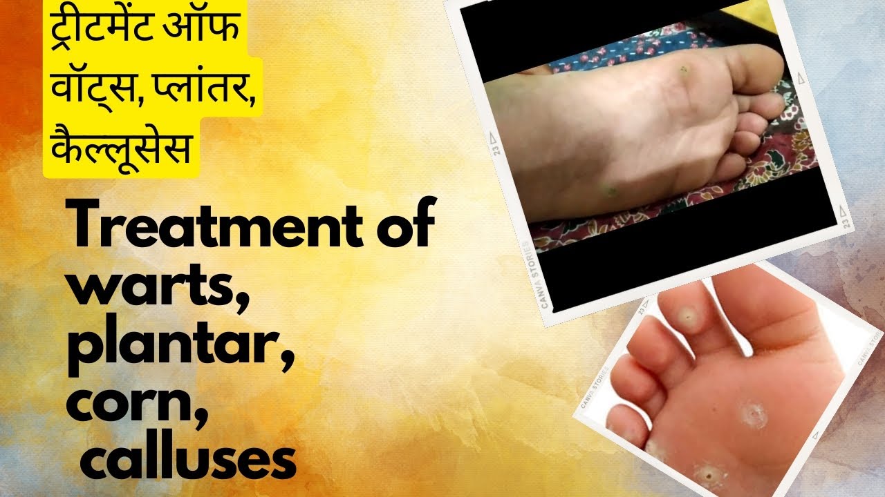 Treatment of warts, plantar, corn & calluses || blakebeautie - YouTube