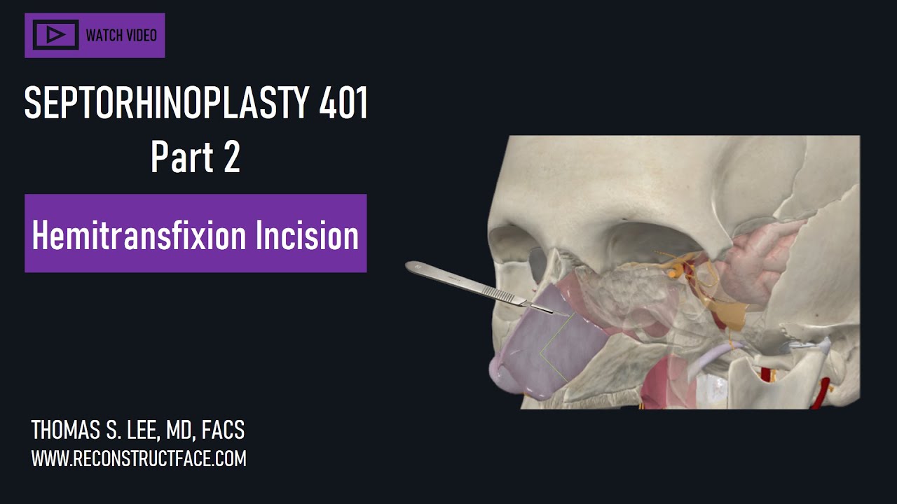Surgery: Hemitransfixion Incision, Developing septal mucosal flap ...