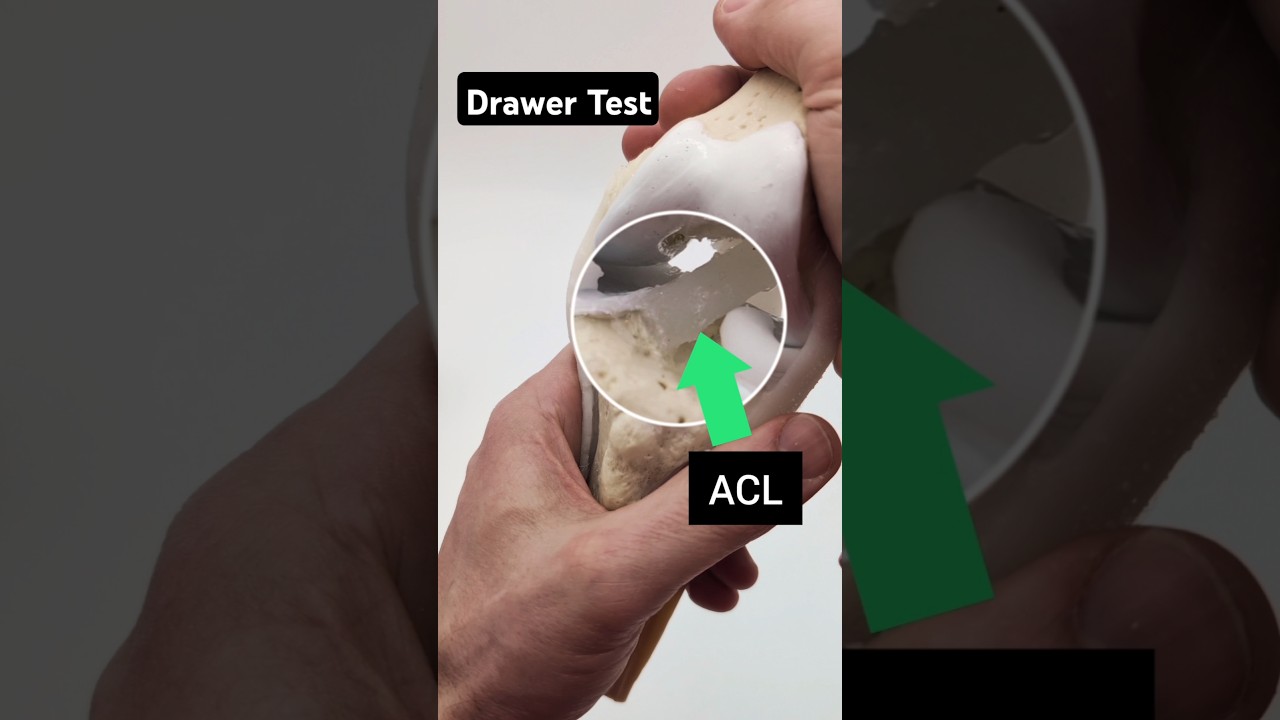 Drawer Test.#acl #knee - YouTube