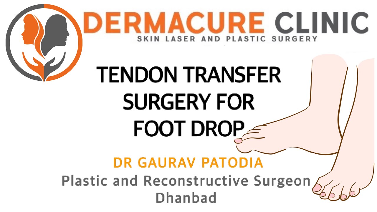 Tendon Transfer Surgery for Foot Drop | Dr Gaurav Patodia | Dhanbad ...