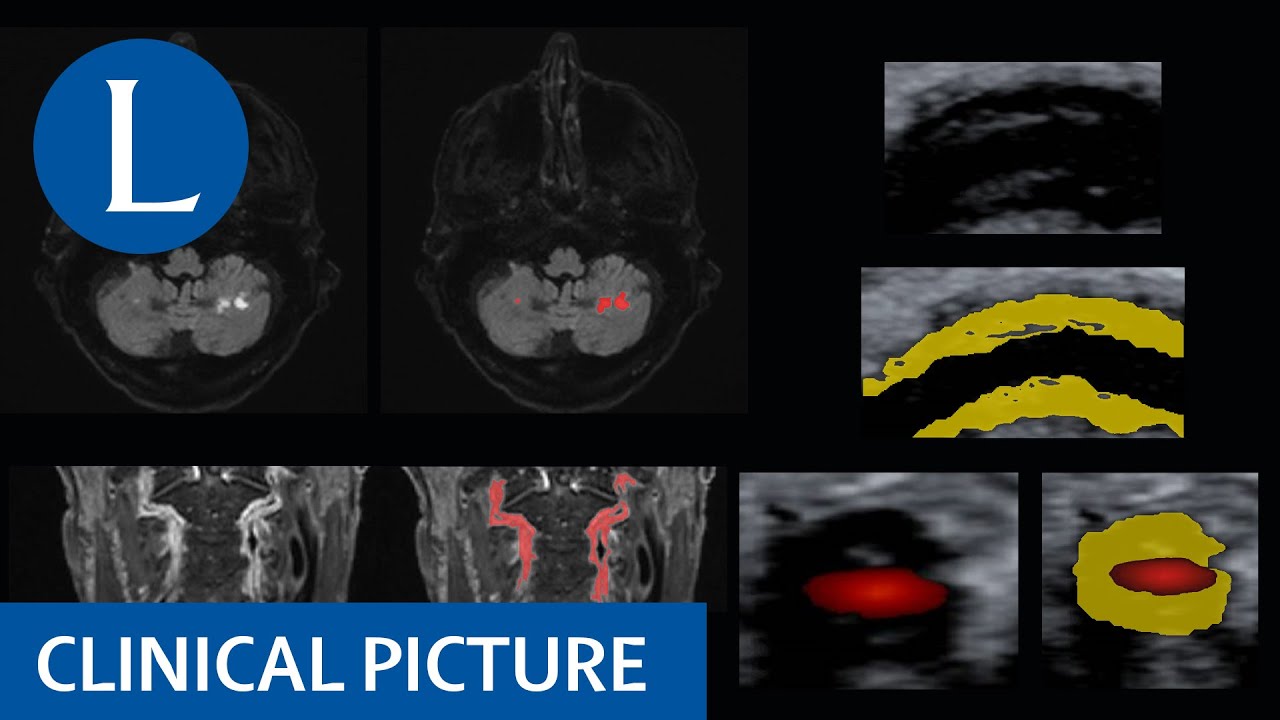 Vertebral artery halo sign in giant cell arteritis - YouTube