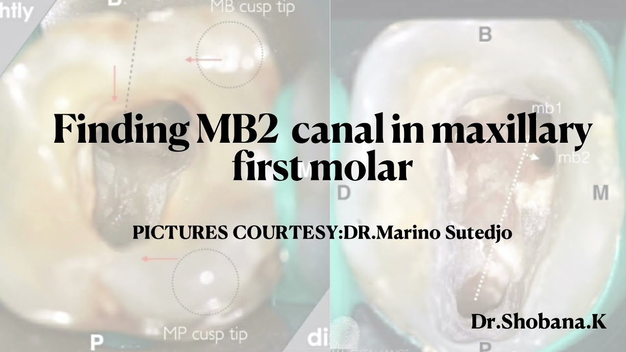Finding MB2 Canal in Maxillary First Molar - YouTube
