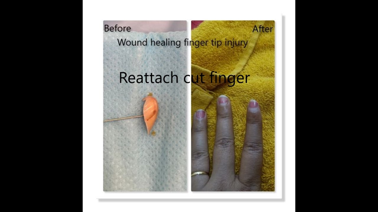 Amazing fingertip repair, finger regenration. how to regenerate finger ...