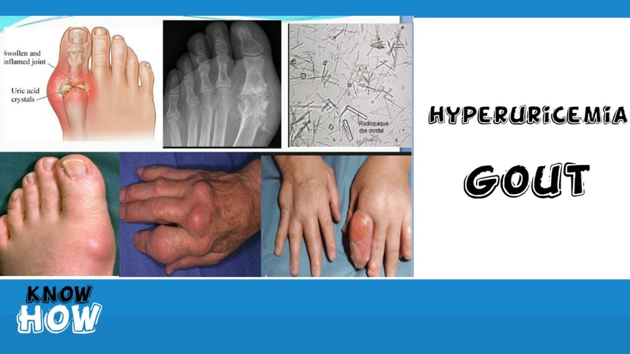 Hyperuricemia and Gout - YouTube