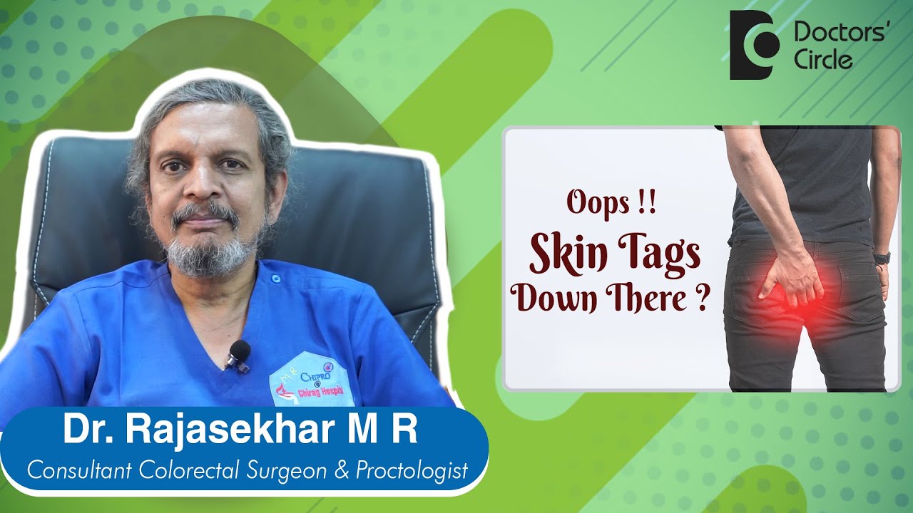 ANAL SKIN TAGS -Irritating down there? Cause,Symptom & Treatment-Dr.Rajasekhar M R | Doctors ...