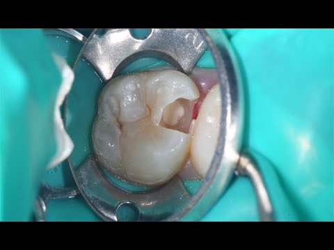 Direct pulp capping with Bright MTA Capping (Prof.Duck-Su Kim) - YouTube