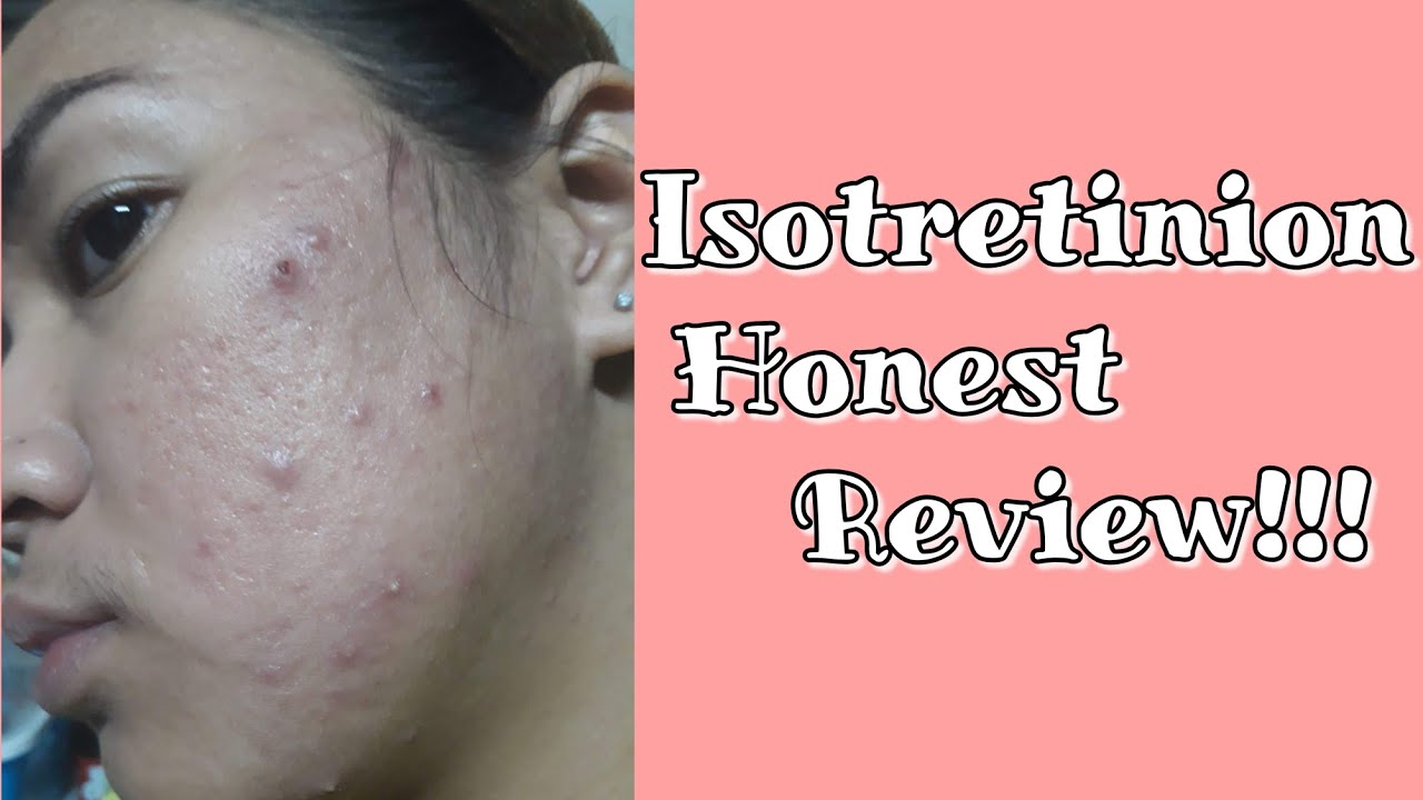 ISOTRETINION BEST TREATMENT FOR ACNE!!! - YouTube