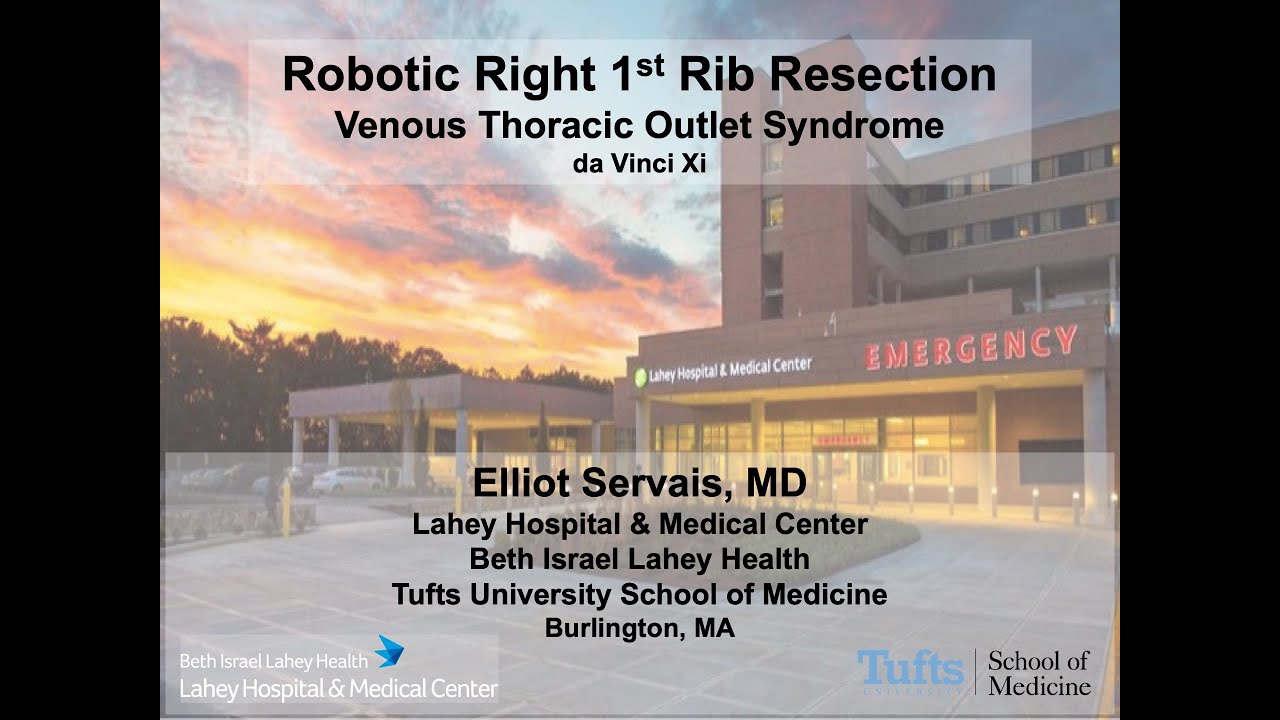 Robotic first rib resection - YouTube