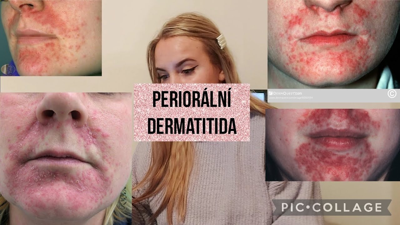 PERIORÁLNÍ DERMATITIDA|VZNIK, PRŮBĚH, LÉČBA - YouTube