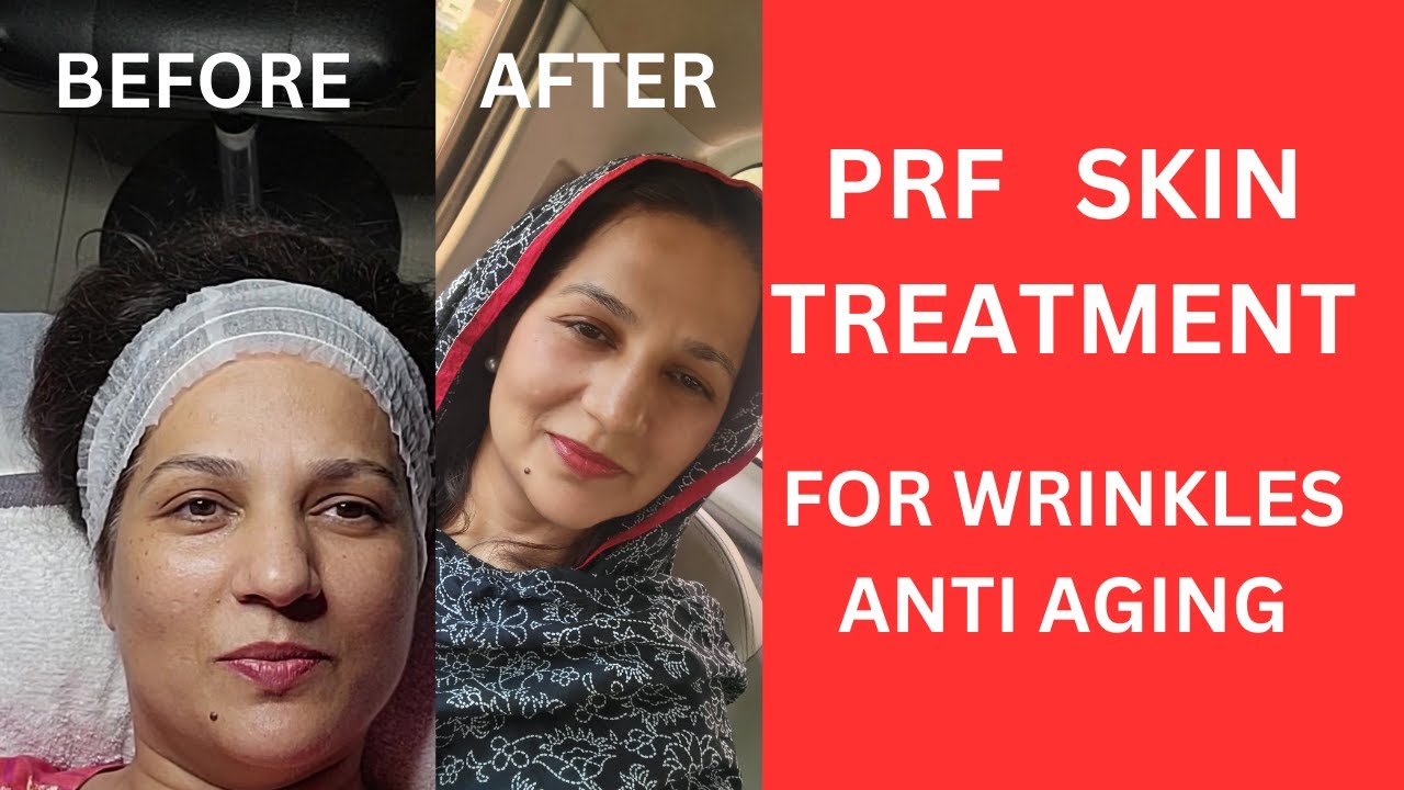 PRF SKIN TREATMENT/ ANTI AGING - YouTube