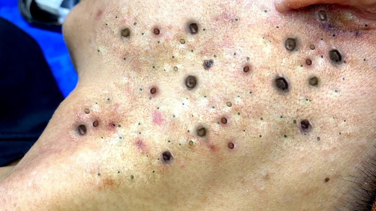 𝐄𝐱𝐭𝐫𝐞𝐦𝐞 𝐁𝐥𝐚𝐜𝐤𝐡𝐞𝐚𝐝 𝐑𝐞𝐦𝐨𝐯𝐚𝐥 𝐚𝐭 𝐋𝐍𝐆 𝐒𝐤𝐢𝐧 𝐂𝐚𝐫𝐞 # 58609 - YouTube