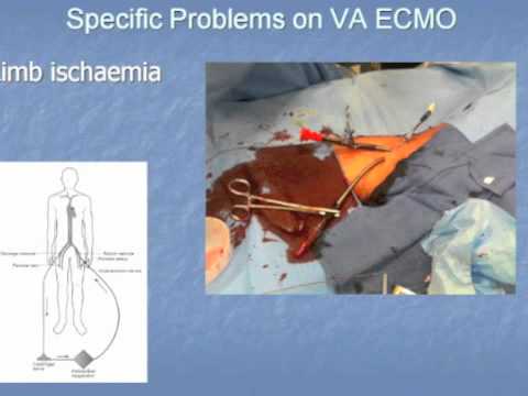 ICN ECMO Part 2 - YouTube