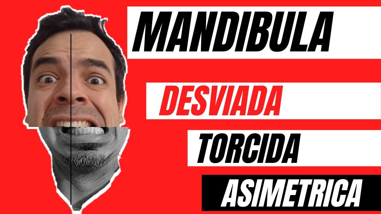 POR QUE TENGO LA CARA TORCIDA? ¿como se corrige la asimetría facial ...