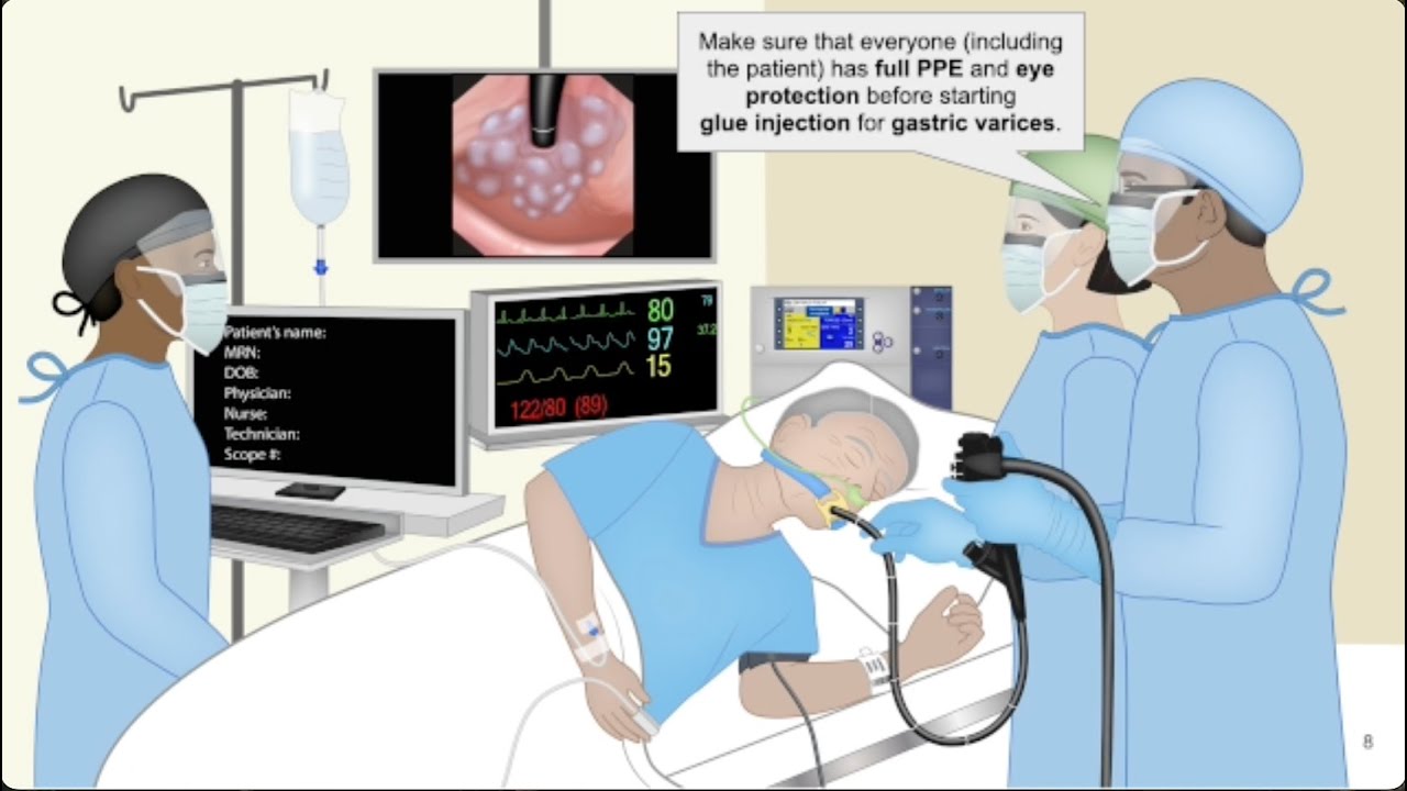 Liver Cirrhosis-Portal HTN-4a-Gastric Vx Bleeding-Endoscopic Glue ...