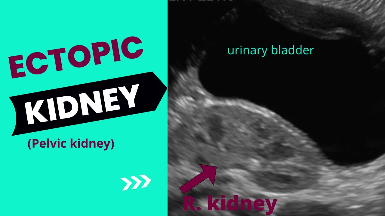 Ultrasound video showing An Ectopic Kidney | Renal Ectopia | Pelvic ...