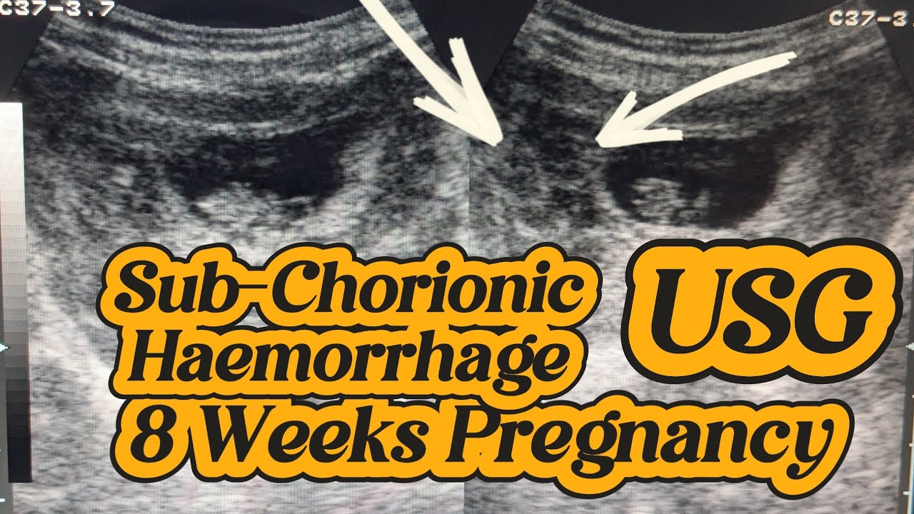 Sub Chorionic Hemorrhage | 8 Weeks Pregnancy| Anomaly Scan | Ultrasound ...