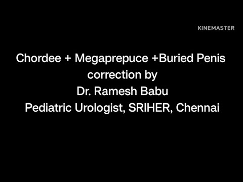 Chordee without hypospadias & Buried Penis correction @Pediatric ...
