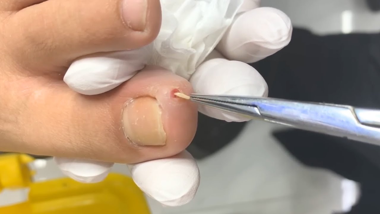 Ingrown Toenail Removal Treatment by Doctor - Toenail Cleaning Pedicure ...
