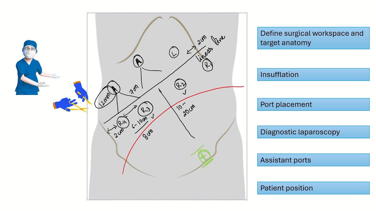 Principles of robotic port position and docking : Da Vinci Xi system ...