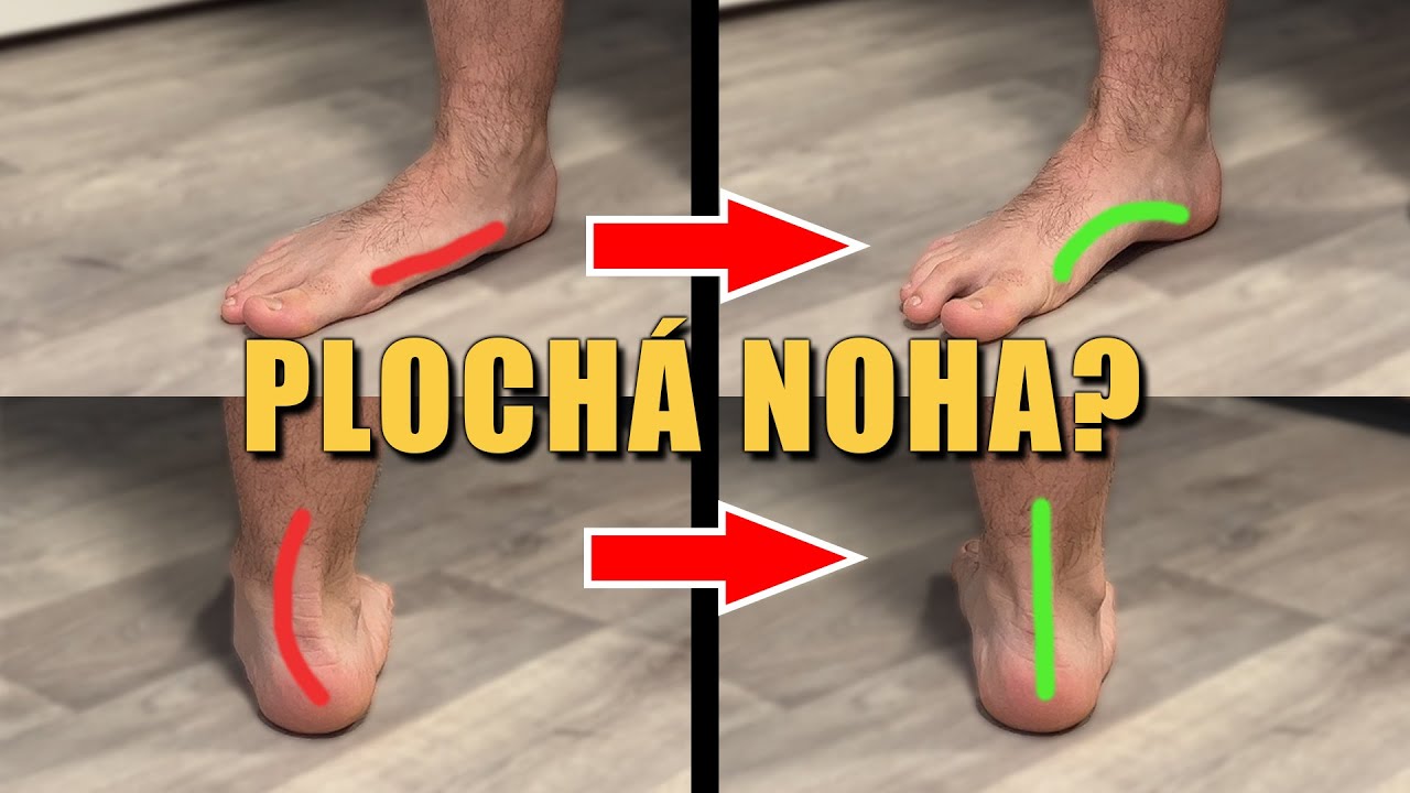 Jak se Zbavit Ploché Nohy? - YouTube