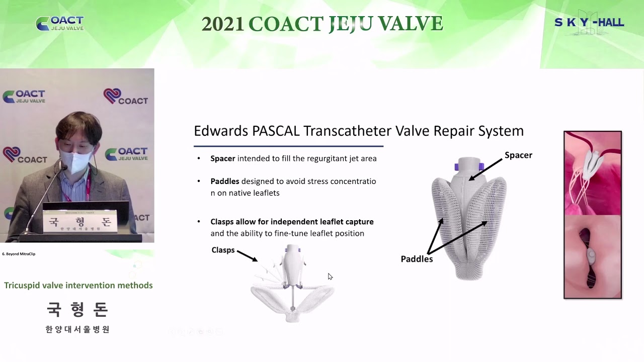 2021 COACT JEJU VALVE 6 (SKY-HALL Day2) : Tricuspid valve intervention ...