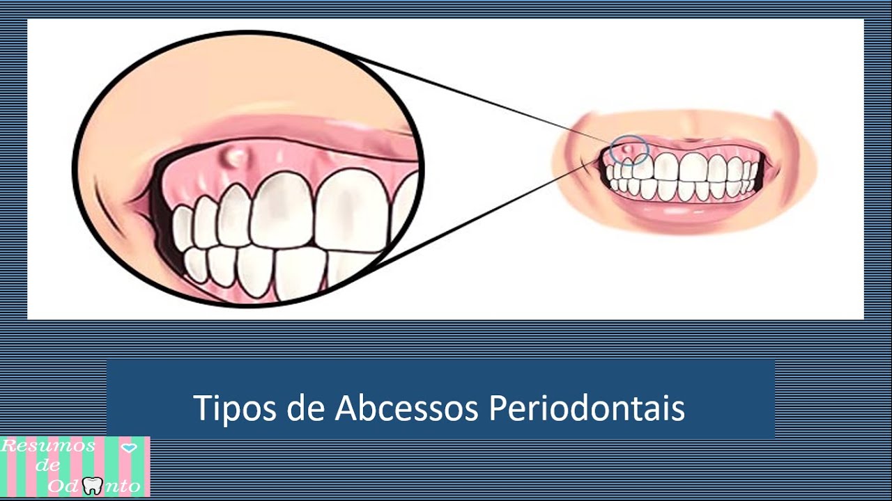 Abcessos Periodontais | Doenças em 5 minutos - Resumos de Odonto - YouTube