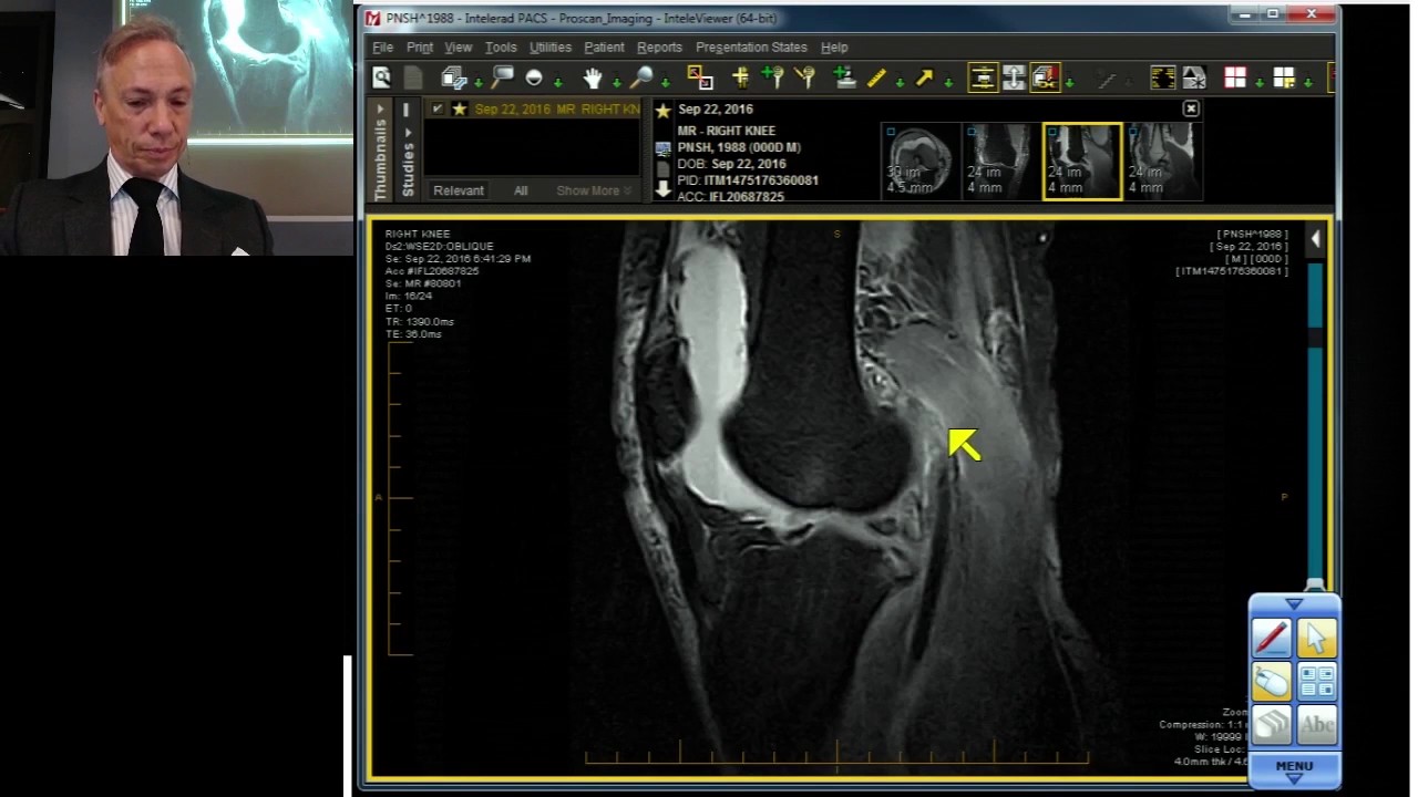 Where Did the Meniscus go? Meniscocapsular Separation Case - YouTube