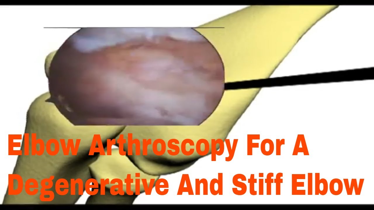 Arthroscopic Elbow Surgery For A Degenerative And Stiff Elbow - YouTube