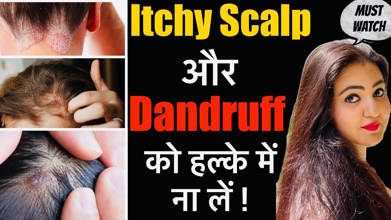 Hair Fall और Hair loss की वजह ये तो नहीं ?? | Scalp Psoriasis Causes ...