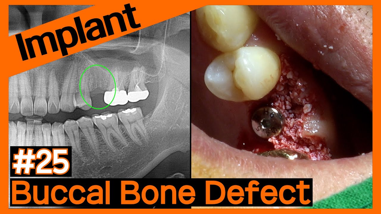[Online Surgery] Implant placement & Intra socket graft using A-Oss ...