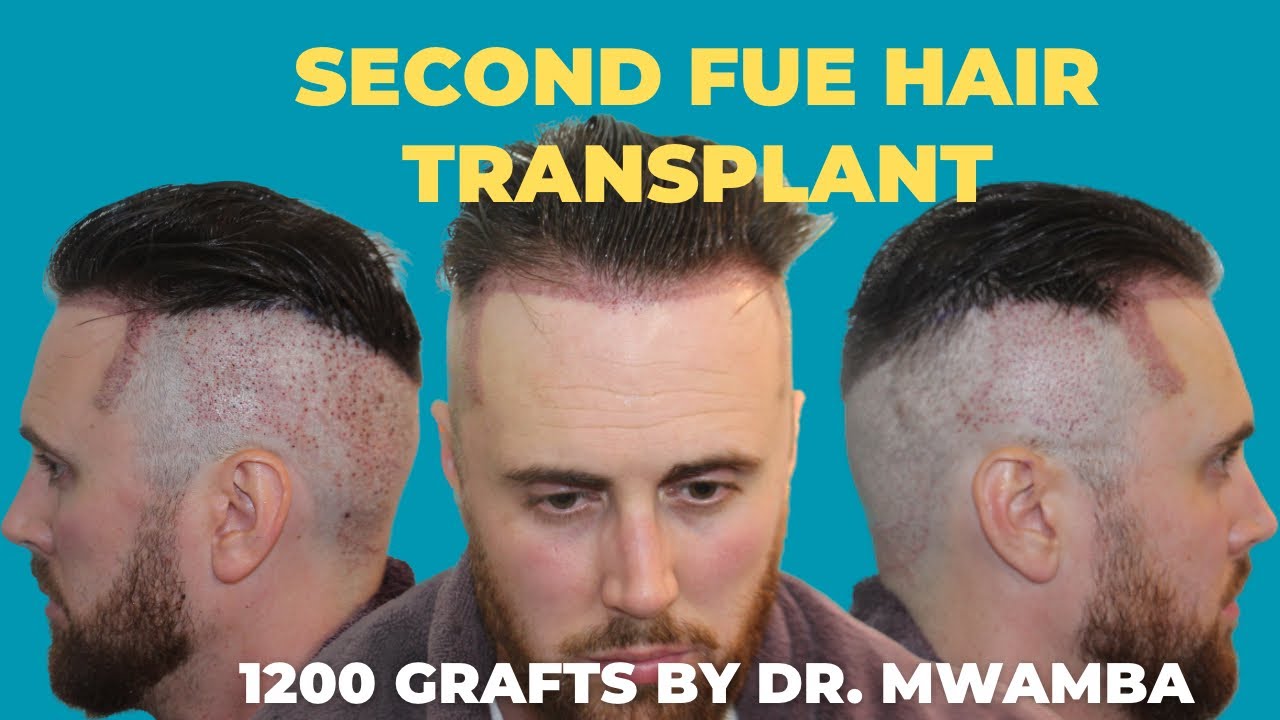 My Second FUE Hair Transplant - 1200 Grafts | Dr. Mwamba - Brussels ...