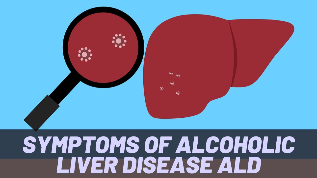 Symptoms of Alcoholic Liver Disease ALD - YouTube