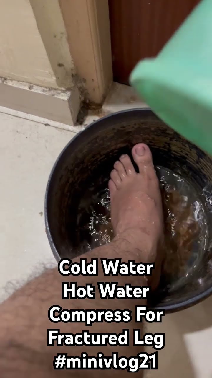 Cold Water Hot Water Compress For Fractured Leg #minivlog21 - YouTube