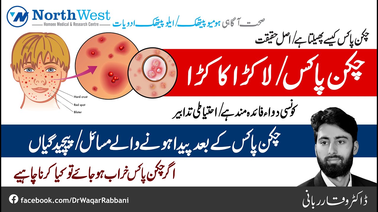 Chicken pox Symptoms Treatment | Chicken pox Ka Ilaj | Lakra Kakra Ka ...