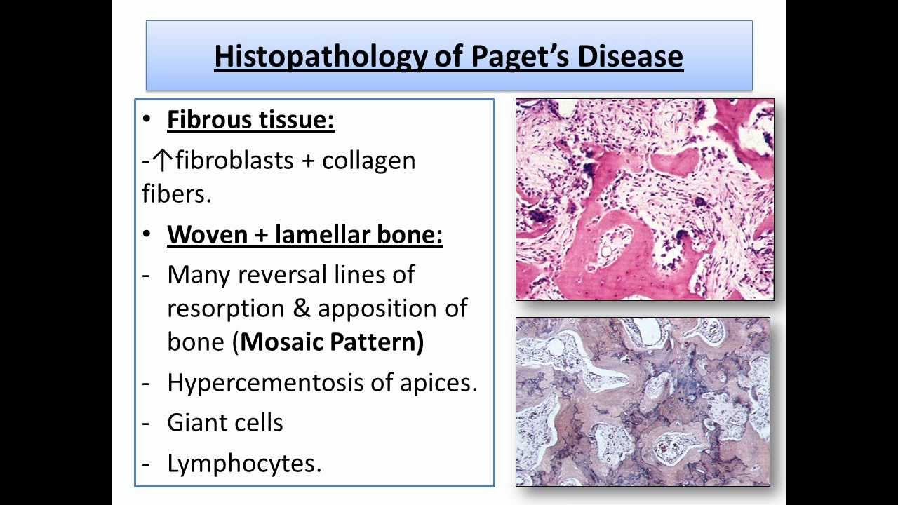 Bone Diseases,(Fibro-osseous & Developmental lesions),(Oral Pathology ...