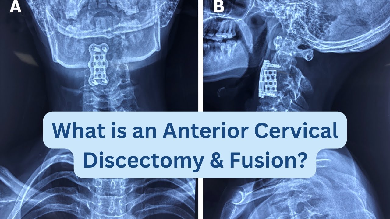 What Is An Anterior Cervical Discectomy And Fusion Youtube
