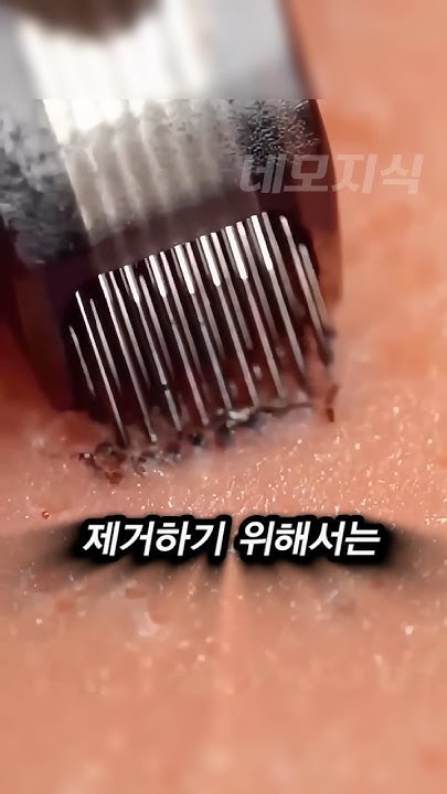 타투를 제거하는 방법 Youtube