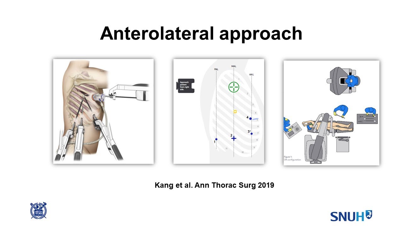 VATS to RATS: What I have learned - part 4 (robotic lobectomy) - YouTube