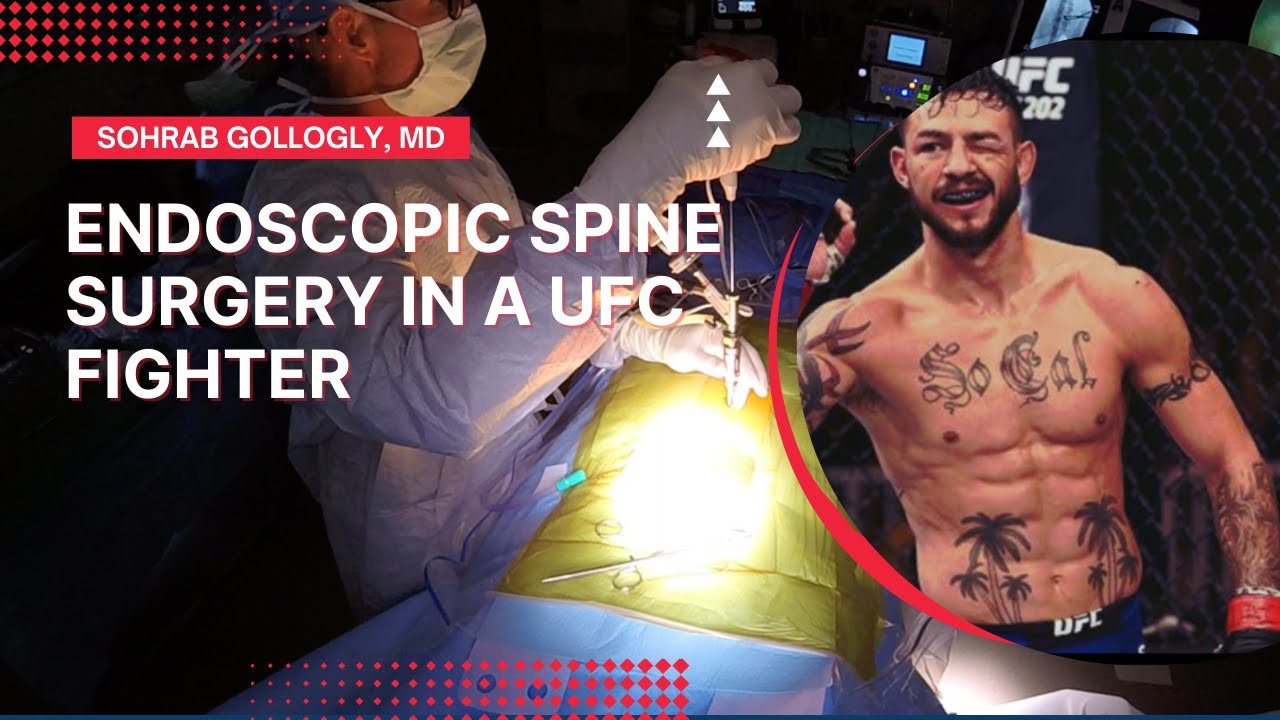 Endoscopic spine surgery on Kevin "Cub" Swanson, a UFC fighter - YouTube