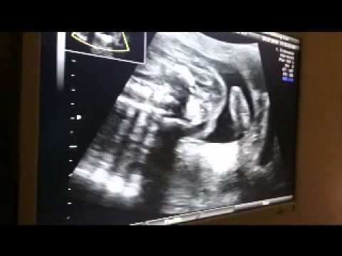 3 D Ultraschall 22. SSW 20.07.2015 - YouTube