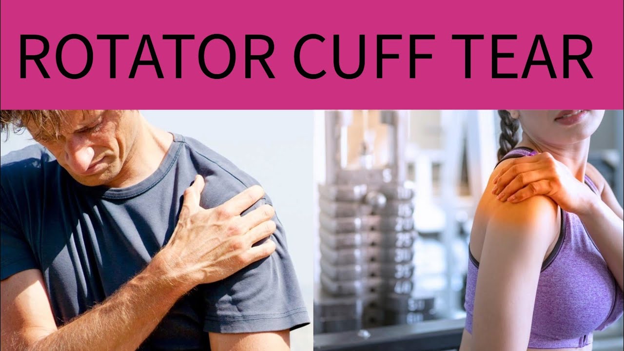 ROTATOR CUFF TEAR| CAUSES| TREATMENT OPTIONS| COMPLETE TEAR By Dr ...