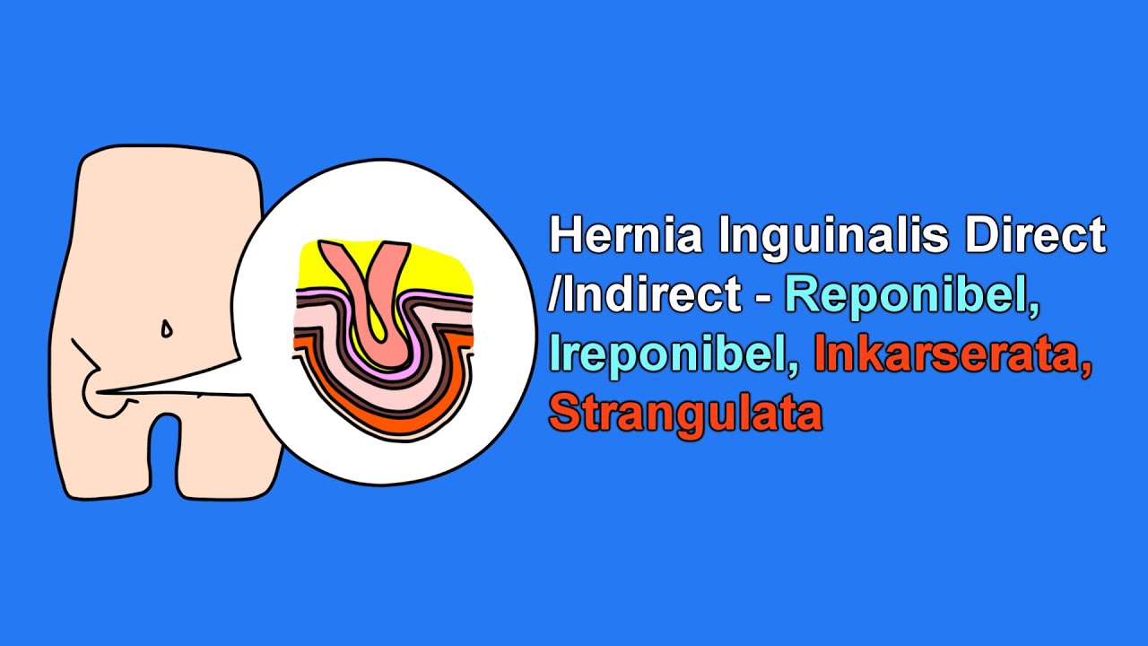 Hernia Abdominalis - Hernia Inguinalis Indirect/Lateralis dan Hernia ...