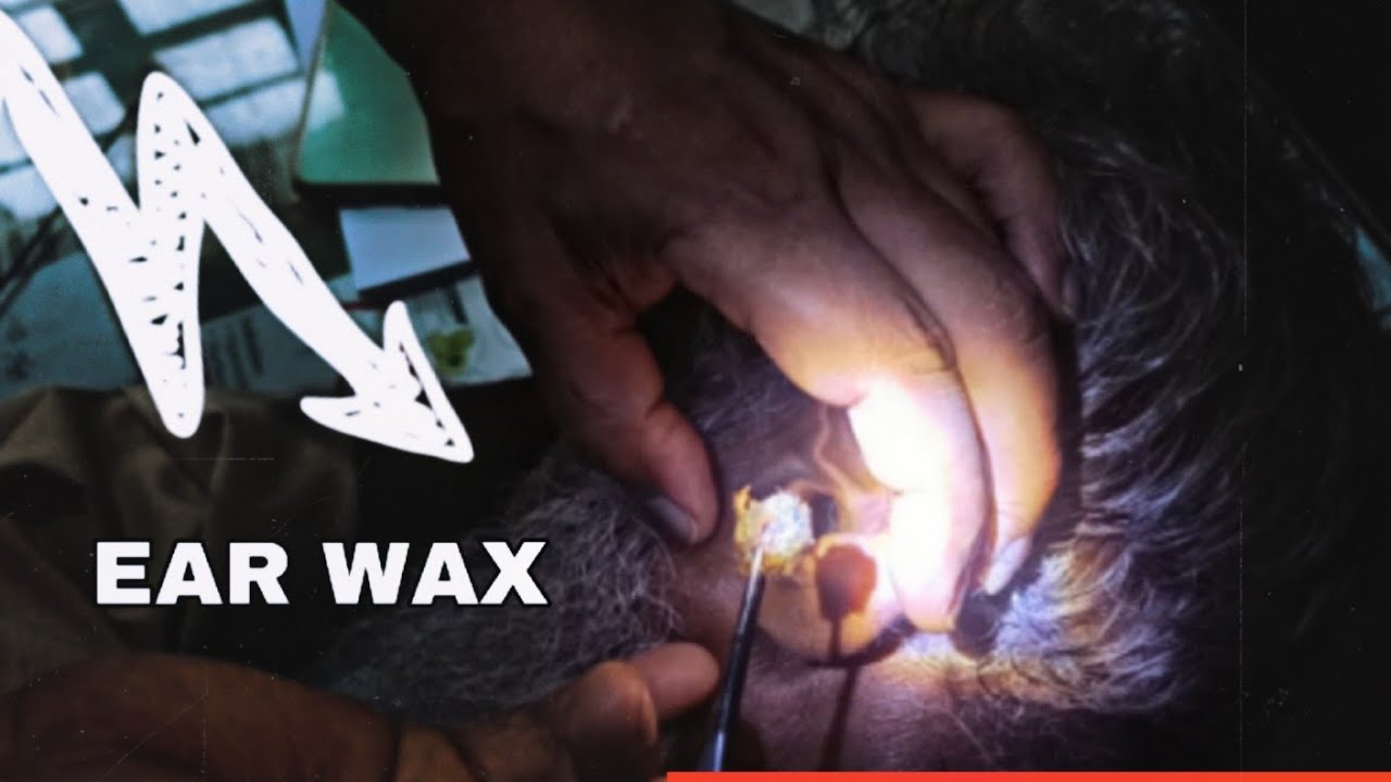 Hard as a rock || Ear Wax Removal.. - YouTube