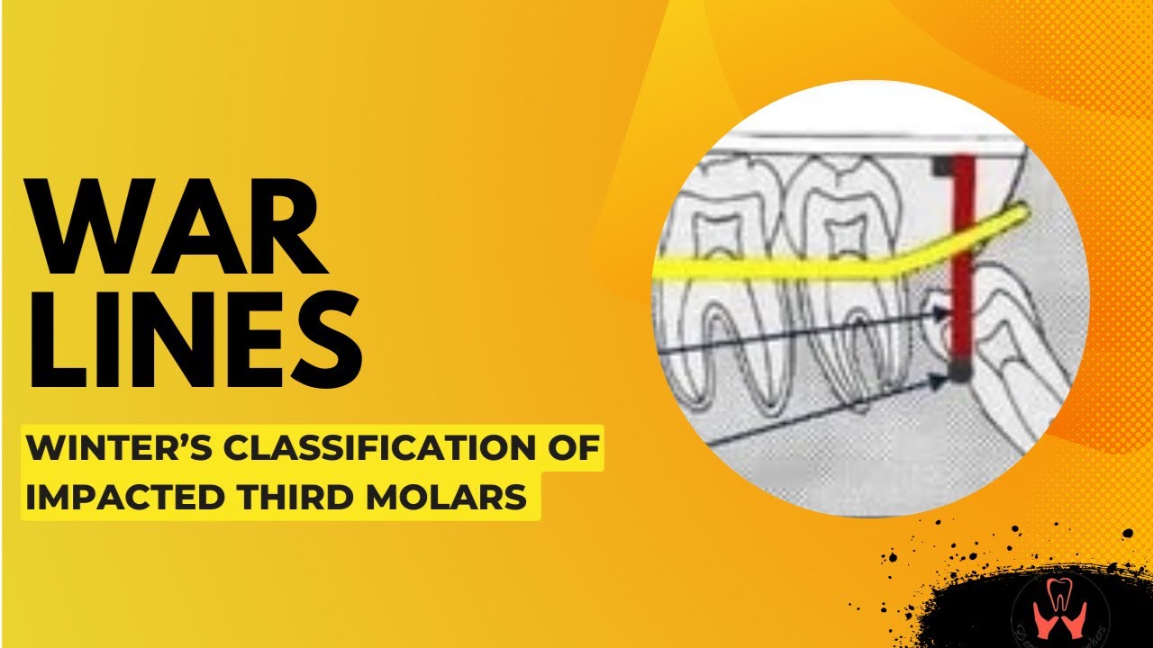 WINTER'S CLASSIFICATION OF IMPACTED THIRD MOLARS || WAR LINES || ORAL ...
