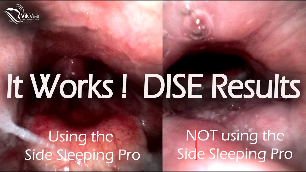 Watch How Side Sleeping Pro Pillow Opens the Airway (Drug Induced Sleep ...