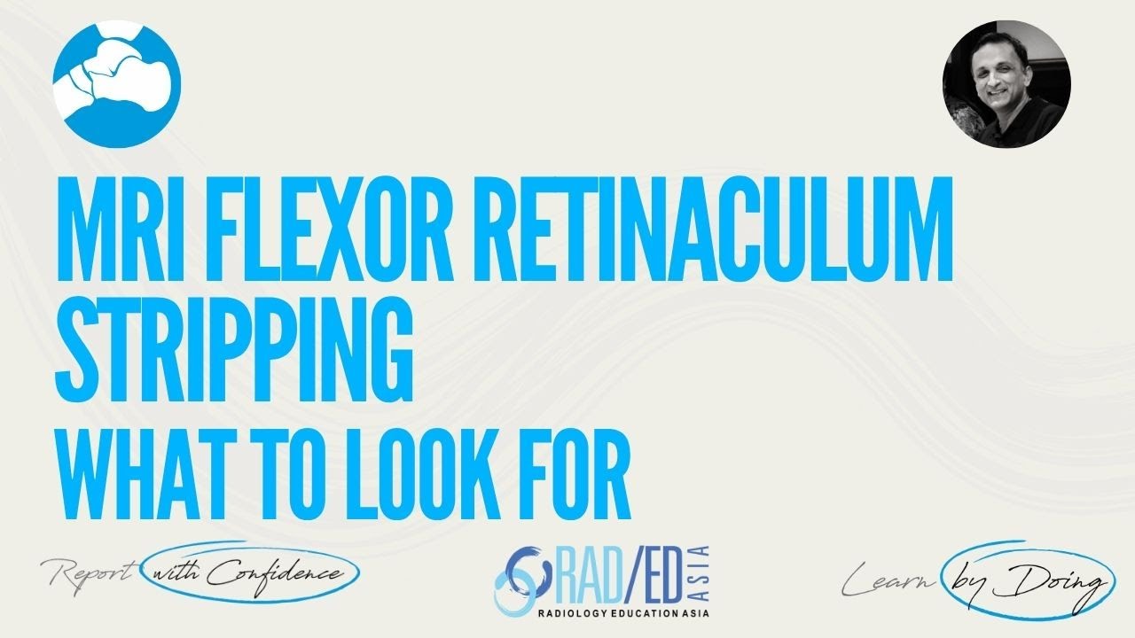 MRI ANKLE: HOW TO IDENTIFY FLEXOR RETINACULUM TEARS AND STRIPPING - YouTube