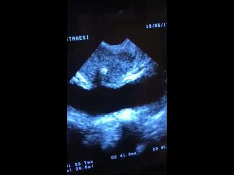 Kronik prostatit'te Enjeksiyon Tedavisinde Ultrason Görüntüsü - YouTube