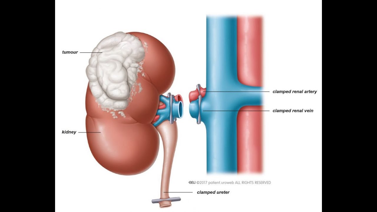Right side Laparoscopic Radical Nephrectomy with Bladder Cuff removal ...