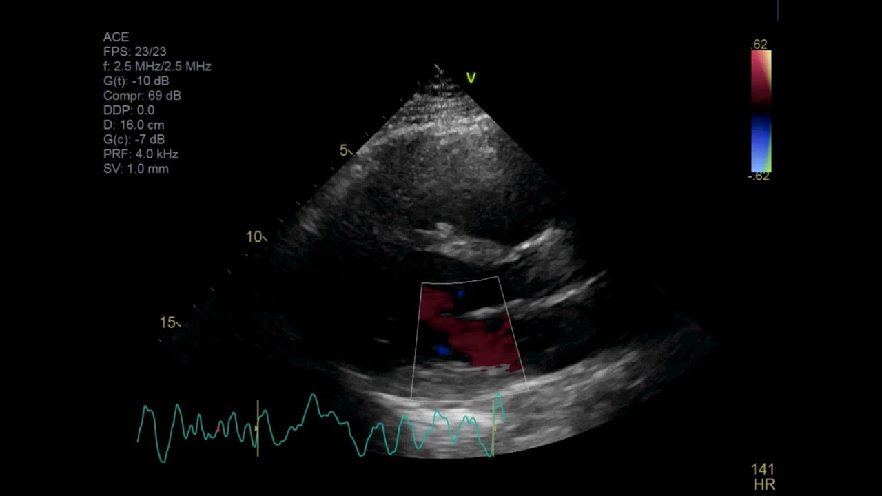 fatal-giant-cell-myocarditis-youtube